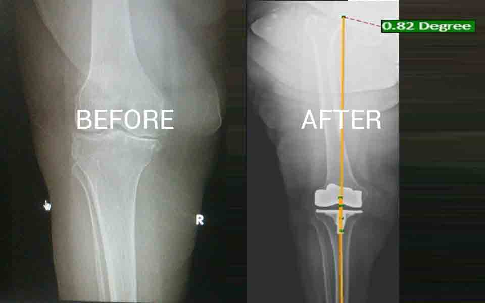 Dr Sunil Kini - Specialist Hip and Knee Surgeon